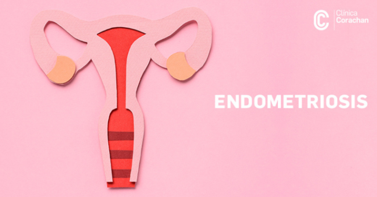 ¿Qué es la endometriosis? | Clínica Corachan